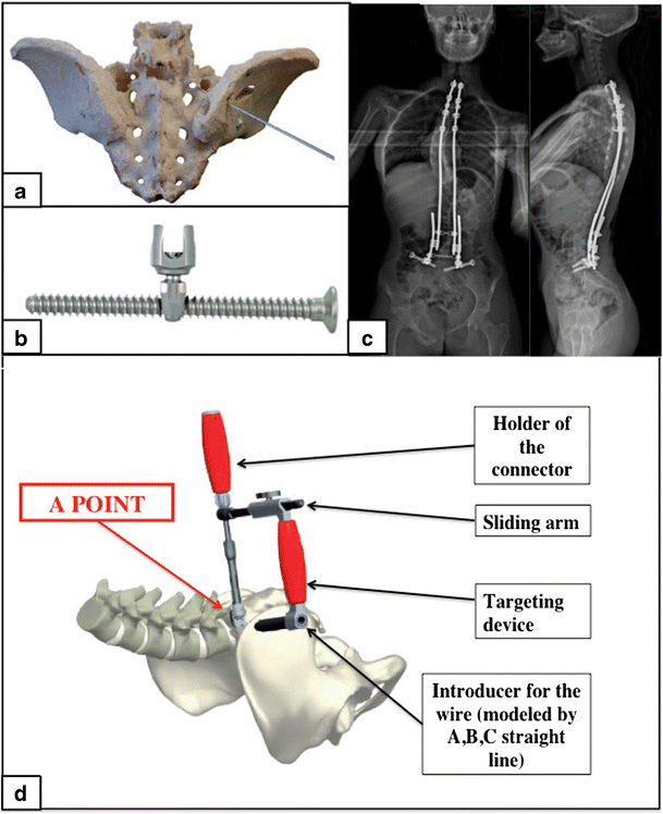 A computed tomographic anatomical study of the upper sacrum ...