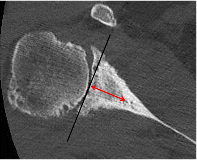 Reverse total shoulder arthroplasty using helical blade to optimize ...