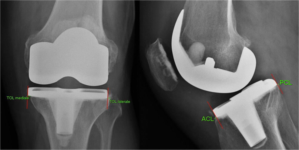 Clinical and radiological analysis of a personalized total knee ...