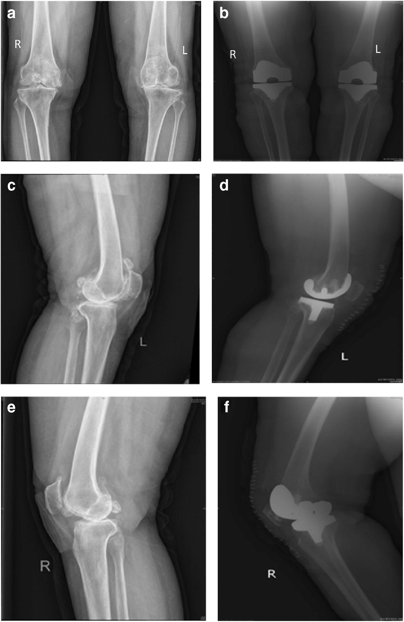 Resurfacing versus not-resurfacing the patella in one-stage bilateral ...