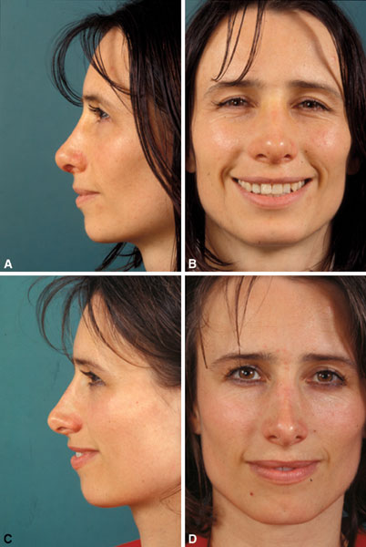 Tragal Cartilage Grafts in Aesthetic Rhinoplasty | SpringerLink