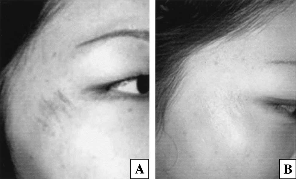 Pulsed Dye Laser Treatment for Linear Scars with Concave and ...