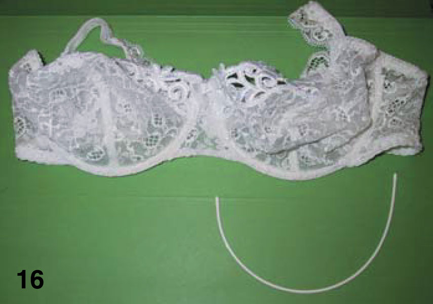 The No Vertical Scar Breast Reduction: A Minor Variation That Allows to ...