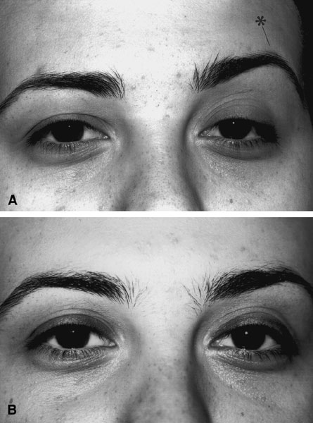 Compensatory Brow Asymmetry: Anatomic Study and Clinical Experience ...