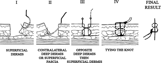The Figure-of-Eight Suture Technique Used for Complicated Wound Closure | SpringerLink