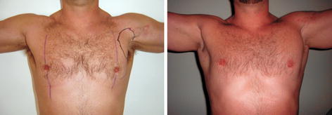 Male Chest Enhancement: Pectoral Implants | SpringerLink