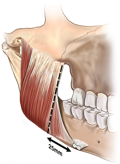 Surgical Anatomy of the Lower Face: The Premasseter Space, the Jowl ...