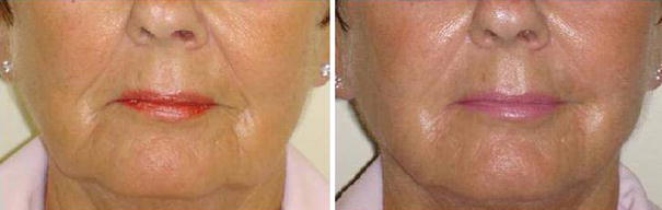 Fat Reduction Using Phosphatidylcholine/Sodium Deoxycholate Injections ...