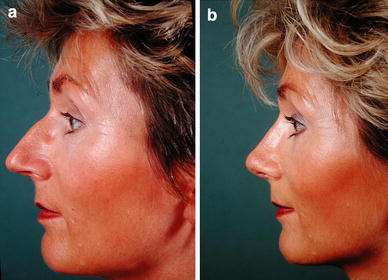 The Sliding Technique: A Method to Treat the Overprojected Nasal Tip ...
