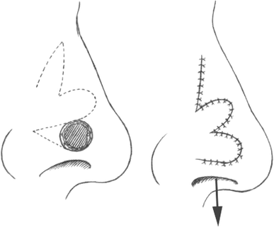The Bilobed Flap for Reconstruction of Distal Nasal Defect in Asians ...