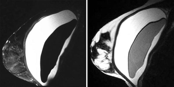 A Clinical Study of Late Seroma in Breast Implantation Surgery ...