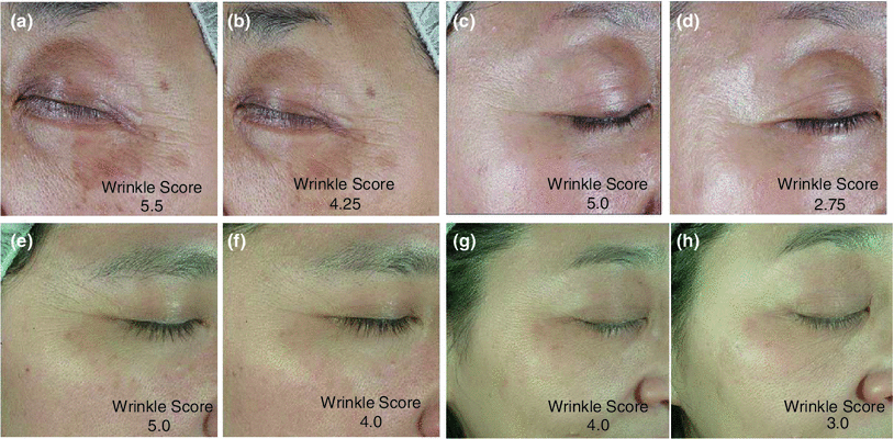 Comparative Evaluation of Wrinkle Treatments | SpringerLink
