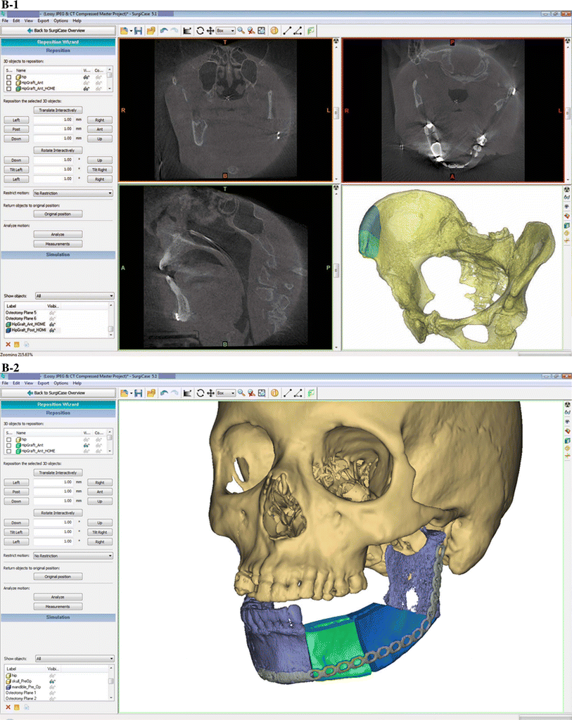 Computer-assisted Mandibular Reconstruction with Vascularized Iliac ...