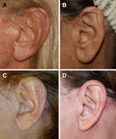 Preauricular Incision Outlining During a Face-Lift: A Step-by-Step ...