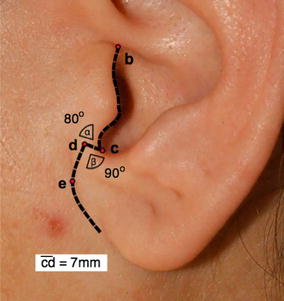 Preauricular Incision Outlining During a Face-Lift: A Step-by-Step ...
