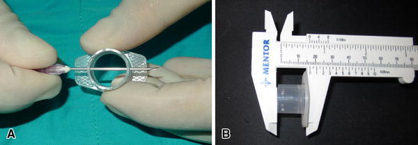 A Minimally Invasive Gradual Traction Technique for Inverted Nipple ...