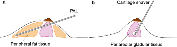 Surgical Correction of Gynecomastia with Minimal Scarring | SpringerLink
