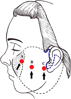 Anatomic Study of the Retaining Ligaments of the Face and Applications ...