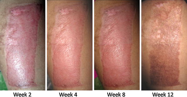 The Efficacy of Combined Herbal Extracts Gel in Reducing Scar ...