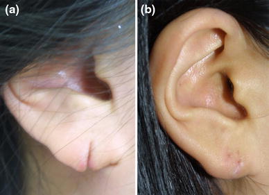 Traumatic Cleft Earlobe Repair: Using a Double Triangular Flap for ...