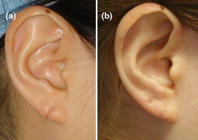 Traumatic Cleft Earlobe Repair: Using a Double Triangular Flap for ...