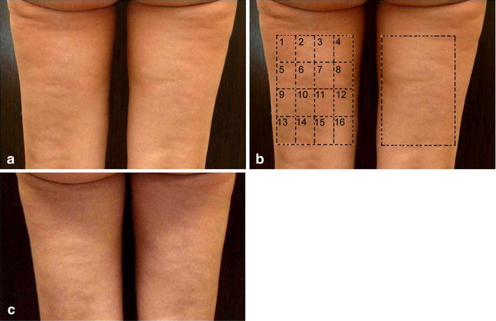 Single Treatment of Grades II and III Cellulite Using a Minimally ...