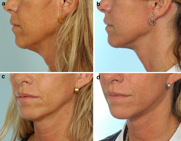 Neck Rejuvenation with Mastoid-Spanning Barbed Tensor Threads (MST ...