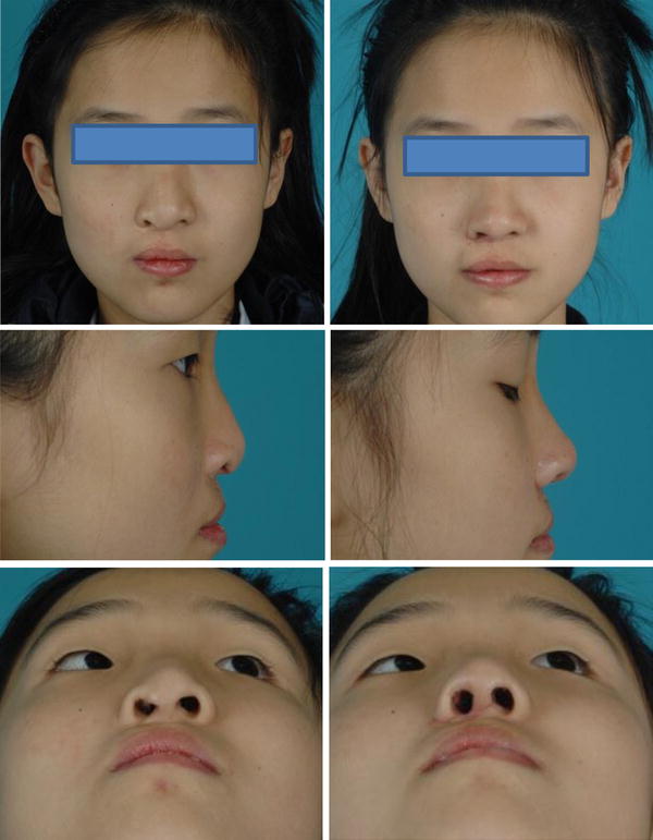 The Correction of Alar–Columella Web Deformities in Unilateral Cleft ...