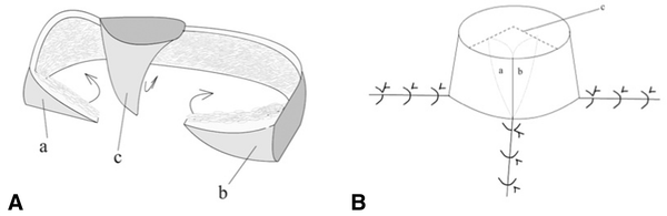 A New Modification of C–V Flap Technique in Nipple Reconstruction ...