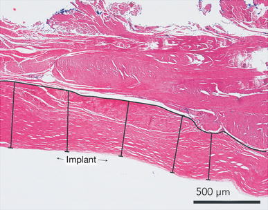 Histological Characterization of Human Breast Implant Capsules ...