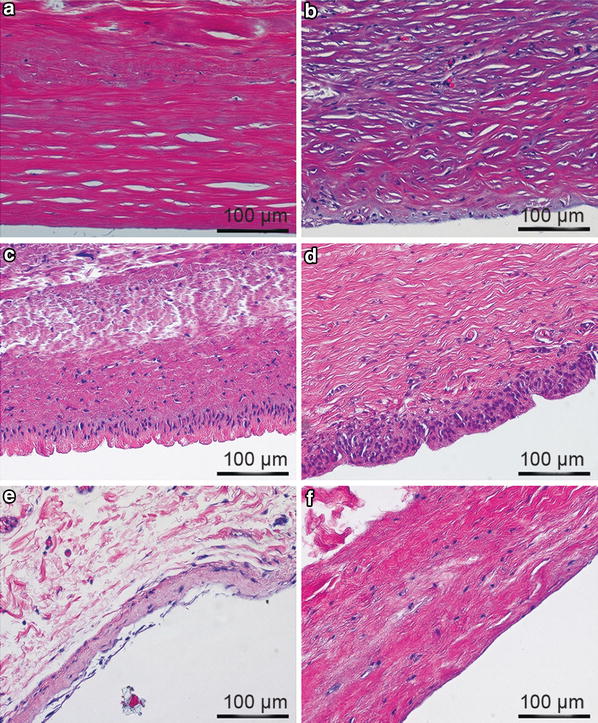 Histological Characterization of Human Breast Implant Capsules ...