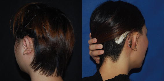An Alternative Posterosuperior Auricular Fascia Flap for Ear Elevation ...