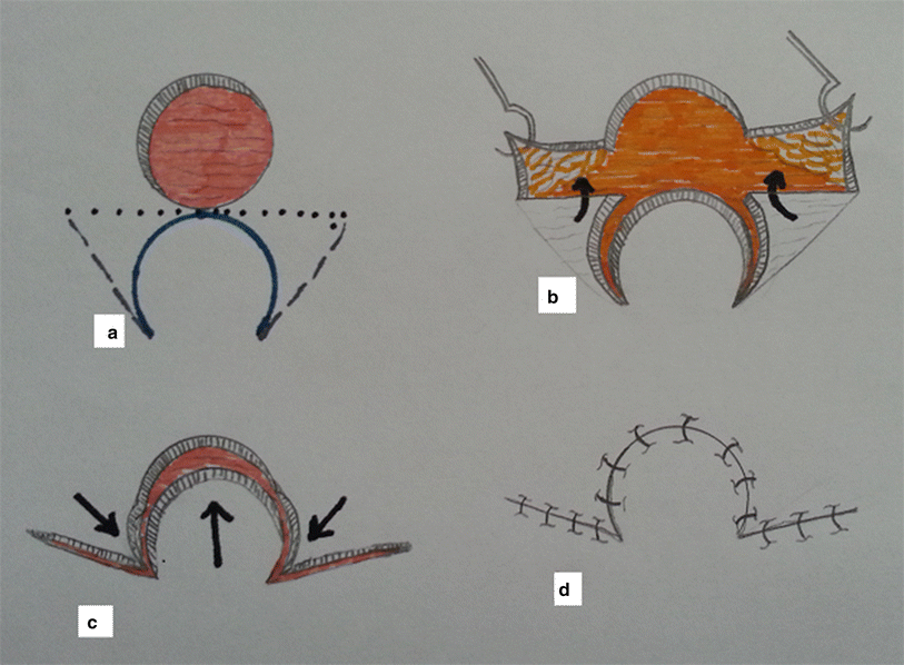 Omega (Ω) Advancement Flap: A Circular Flap Design for the Aesthetic ...