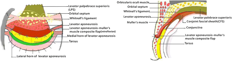 A Modified Levator Resection Technique Involving Retention of the ...