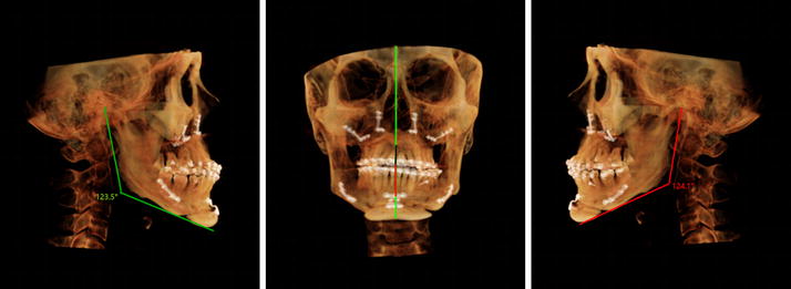The Application of 3D Printing Technology for Simultaneous Orthognathic ...