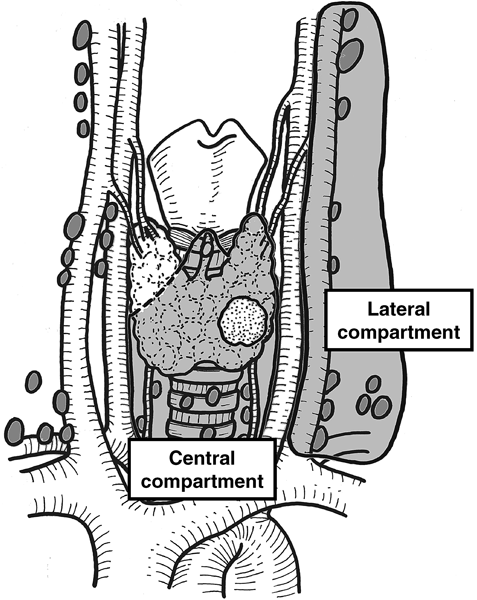 Modified Radical Neck Dissection for Differentiated Thyroid Cancer ...