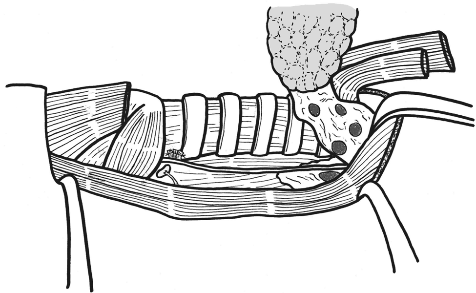 Modified Radical Neck Dissection for Differentiated Thyroid Cancer ...
