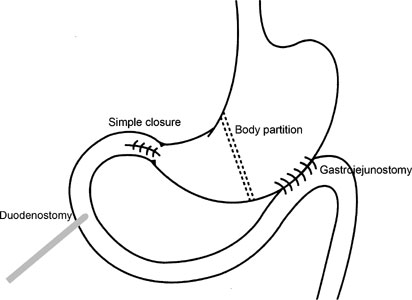 Gastric Body Partition for Giant Perforated Peptic Ulcer in Critically ...