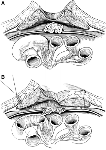 Long-Term Outcome of 254 Complex Incisional Hernia Repairs Using the ...