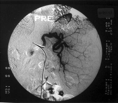 Partial Splenic Embolization Versus Splenectomy for the Management of ...