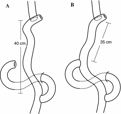 Evaluation of Double Tract Reconstruction After Total Gastrectomy in Patients with Gastric ...