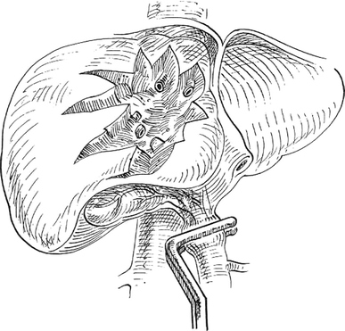 Management of Liver Trauma | SpringerLink