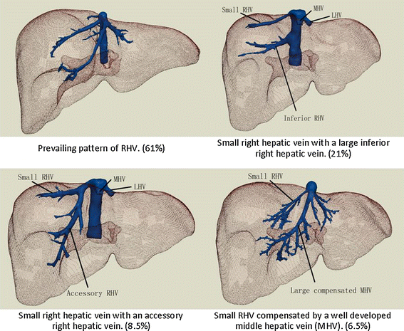 Anatomical Variations of Hepatic Veins: Three-Dimensional Computed ...
