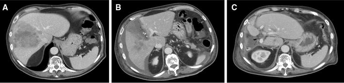 The ALPPS Procedure: A Surgical Option for Hepatocellular Carcinoma ...