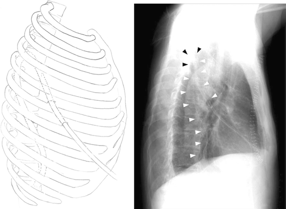 Method of Bilateral Pleural Drainage by Single Blake Drain After ...