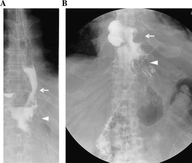 A Novel Technique of Anti-reflux Esophagogastrostomy Following Left ...