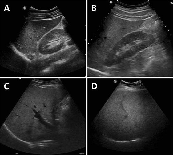 Cholecystectomy Causes Ultrasound Evidence of Increased Hepatic ...