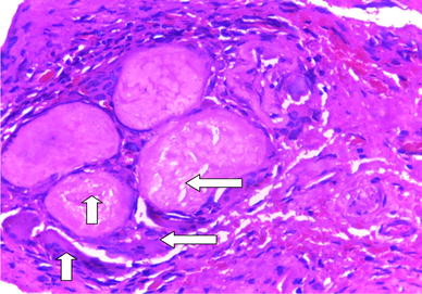 Ranula: Current Concept of Pathophysiologic Basis and Surgical ...