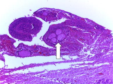 Ranula: Current Concept of Pathophysiologic Basis and Surgical ...