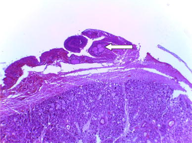 Ranula: Current Concept of Pathophysiologic Basis and Surgical ...